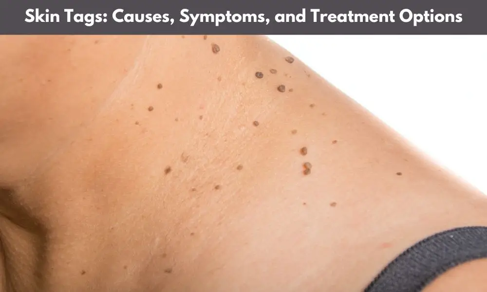 How to Get Rid Of Skin Tags | 10 Easy and Tested Ways